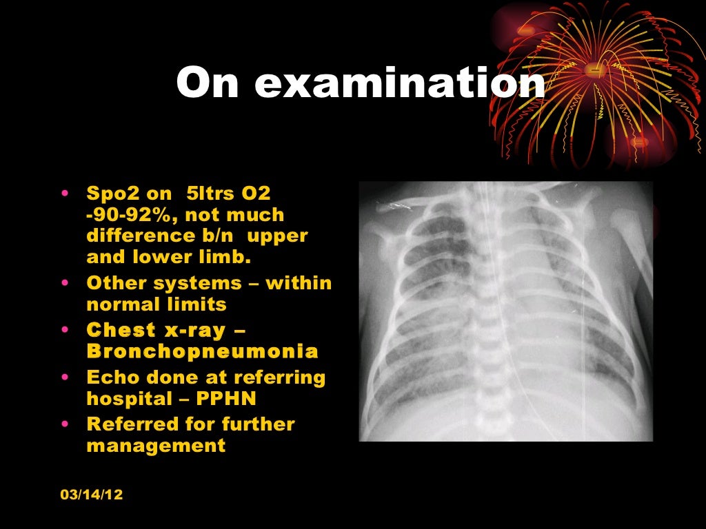 Cyanosis In Term Neonates