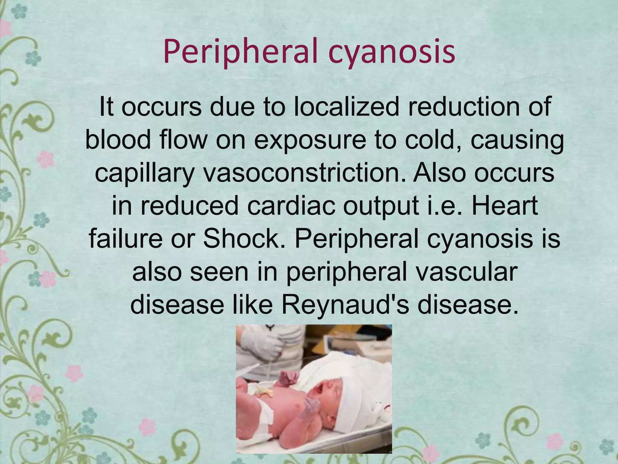 Cyanosis | PPTX