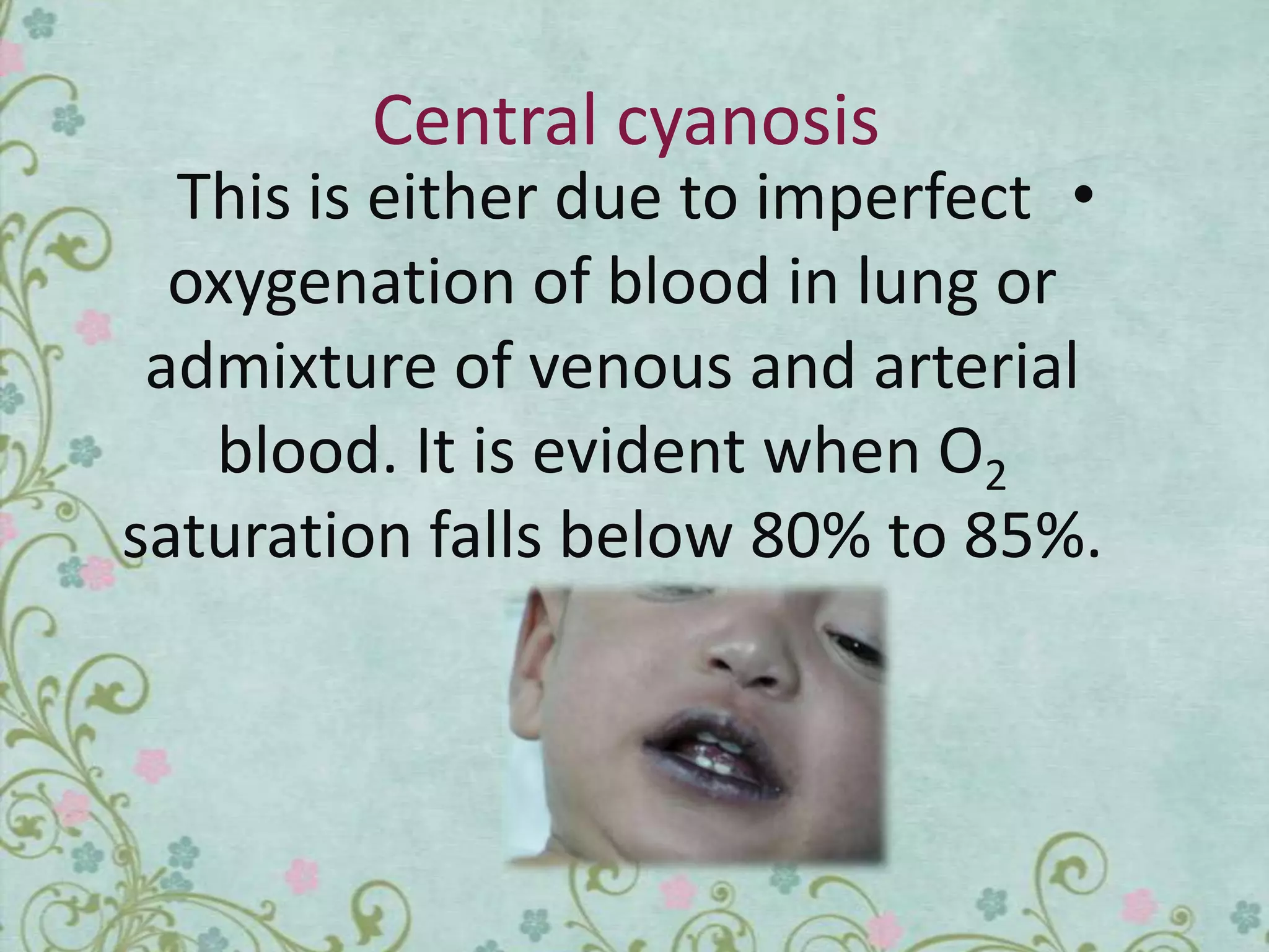 Cyanosis | PPTX