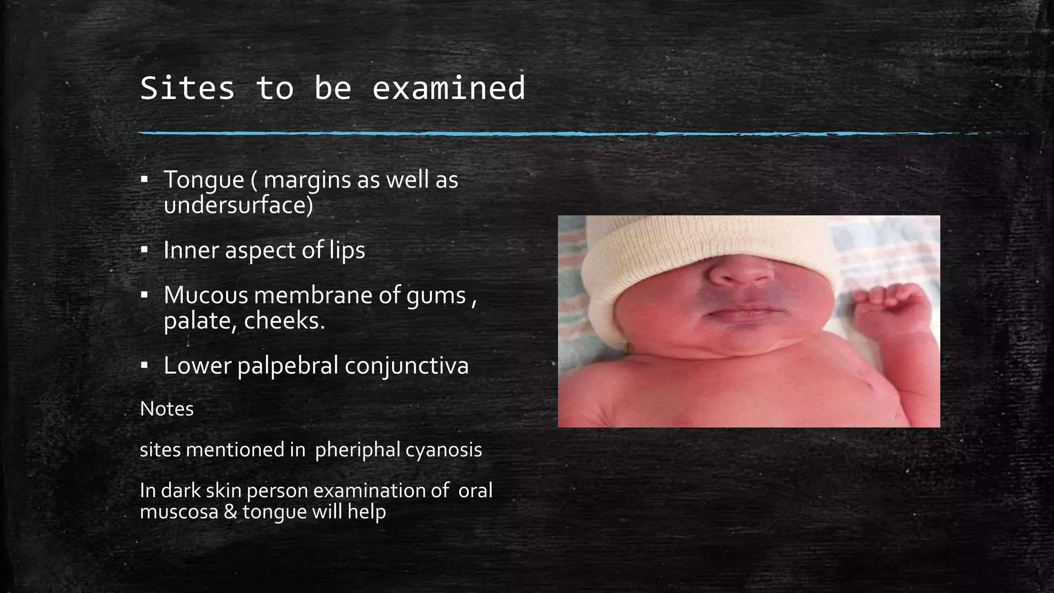 Cyanosis & nail abnormalities | PPTX