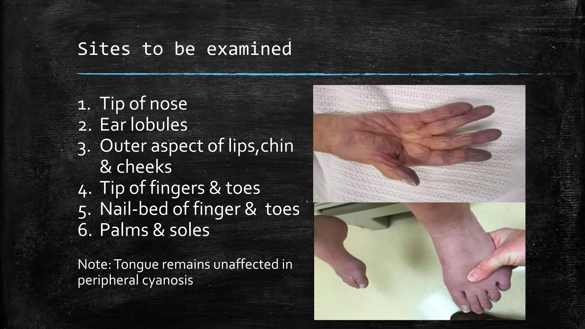 Cyanosis & nail abnormalities | PPTX