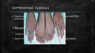 Cyanosis & nail abnormalities | PPTX