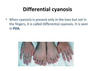 Cyanosis ppt by dr girish jain | PPT