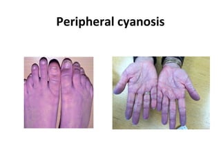 Cyanosis ppt by dr girish jain