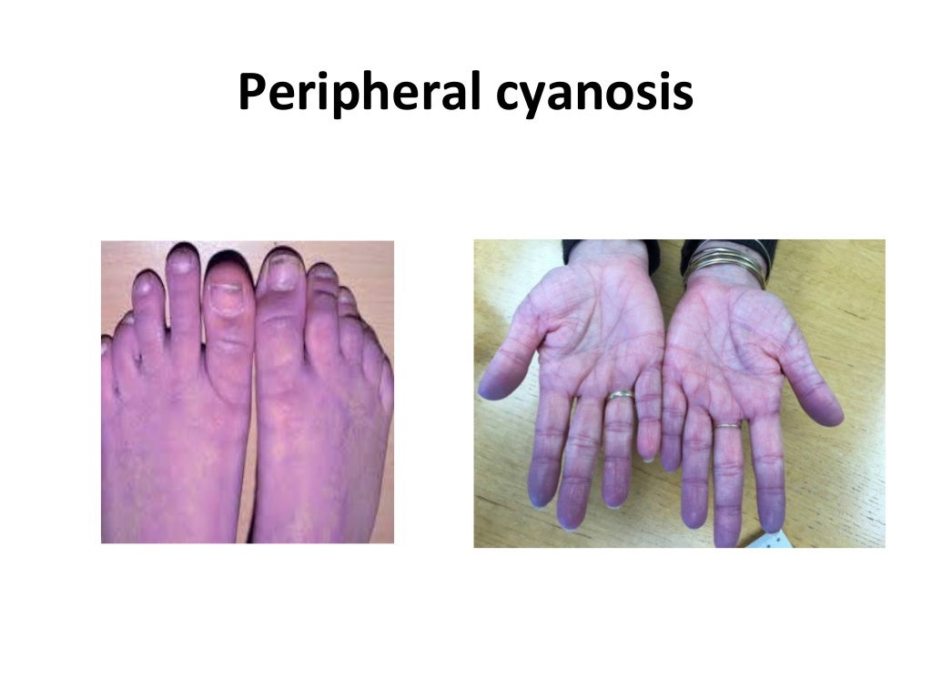 Cyanosis ppt by dr girish jain