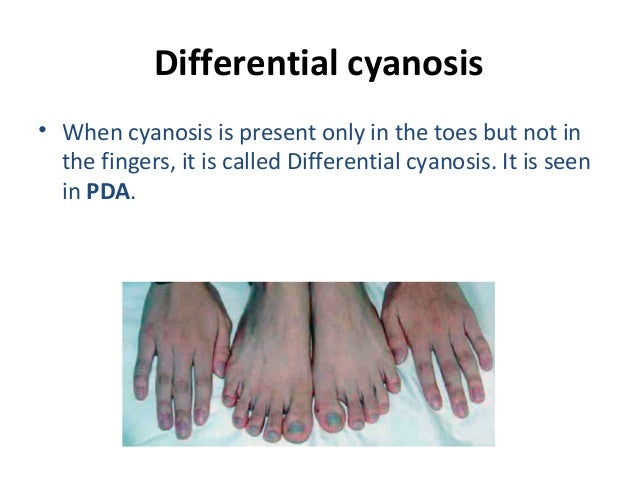 Cyanosis ppt by dr girish jain