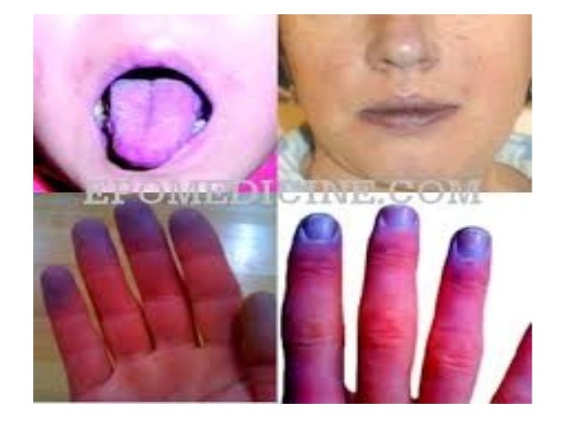 Cyanosis Ppt By Dr Girish Jain