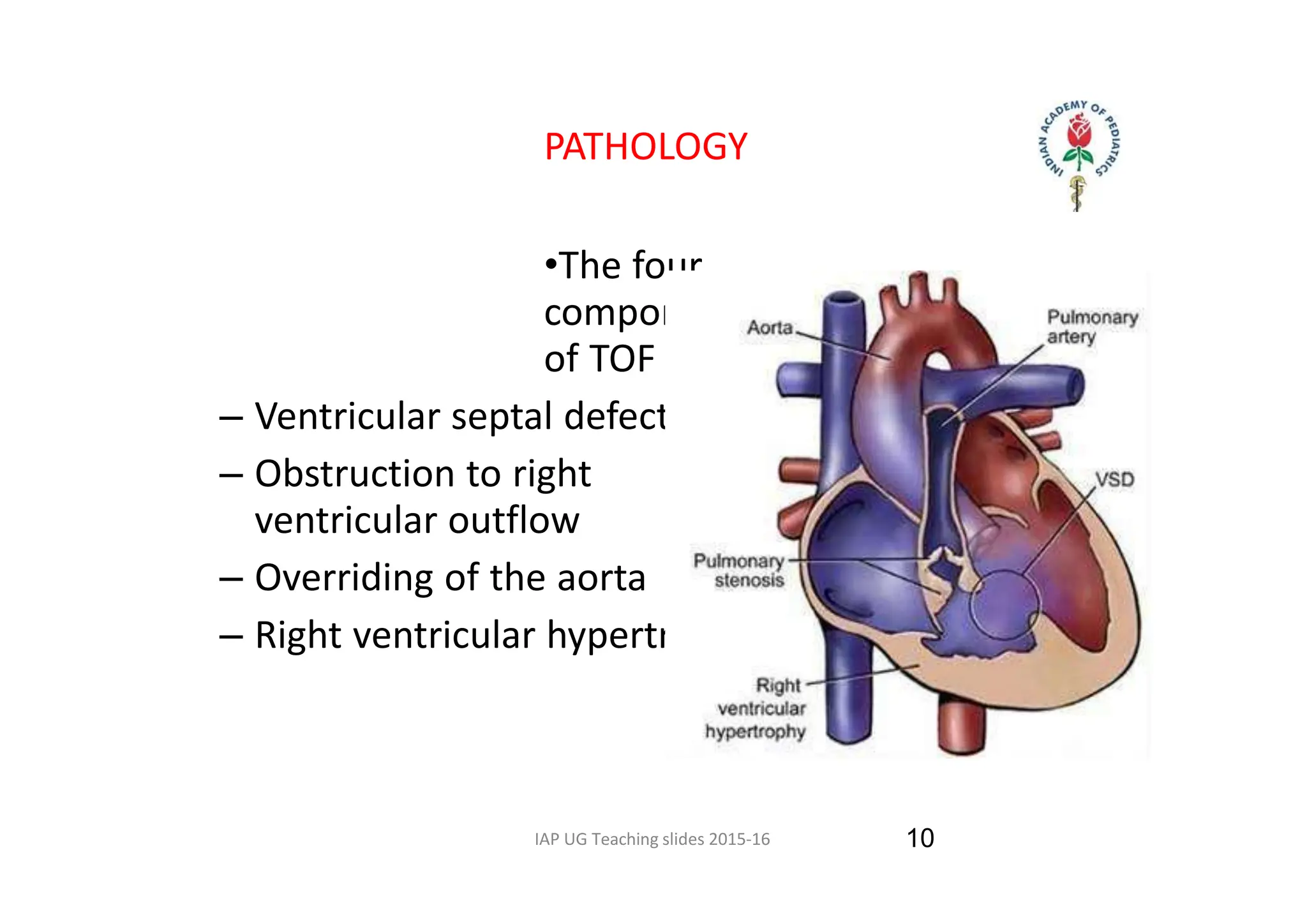 cyanotic-congenital-heart-diseases-iap-ug-teaching-slides_compress.ppt