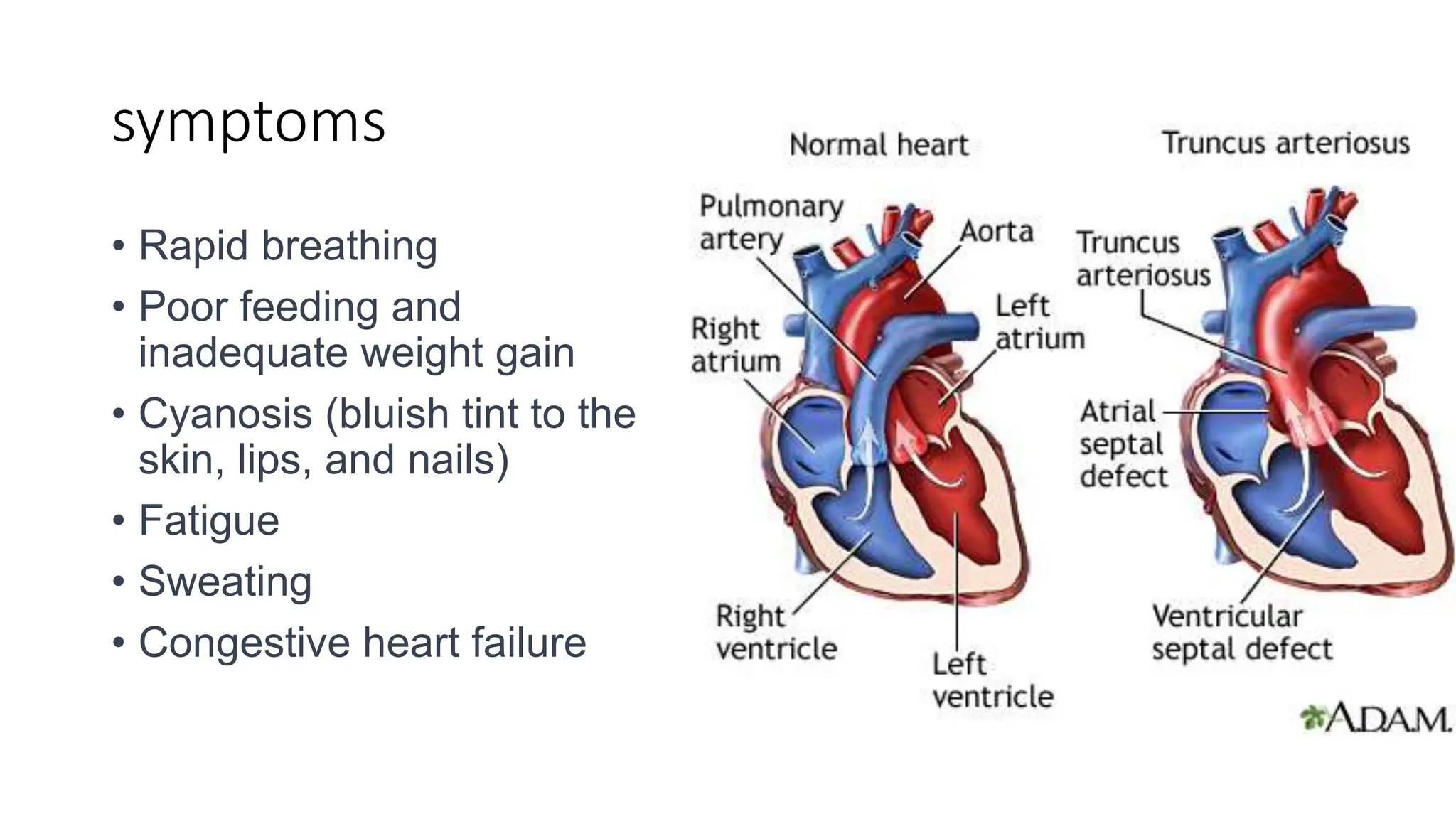cyanotic congenital heart defects.pptx