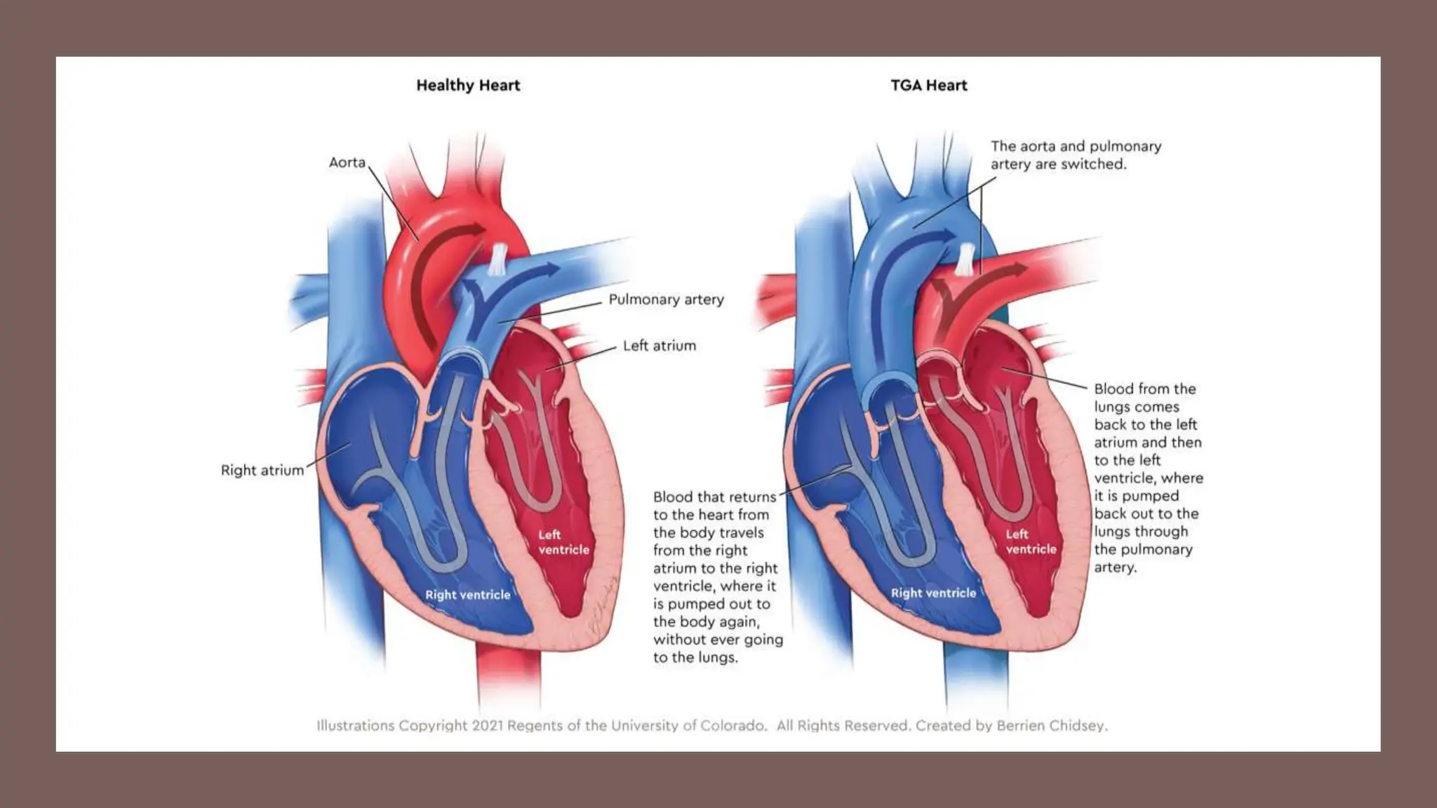 cyanotic congenital heart defects.pptx