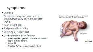 cyanotic congenital heart defects.pptx