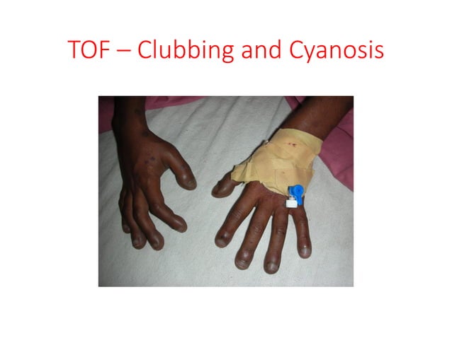 Cyanotic congenital heart disease 2021 | PDF