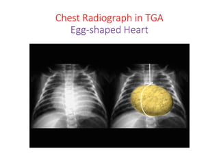 cyanoticcongenitalheartdisease2021-210214173958 (1).pptx