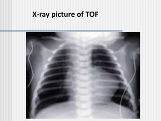 Cyanotic congenital heart diseases | PPT