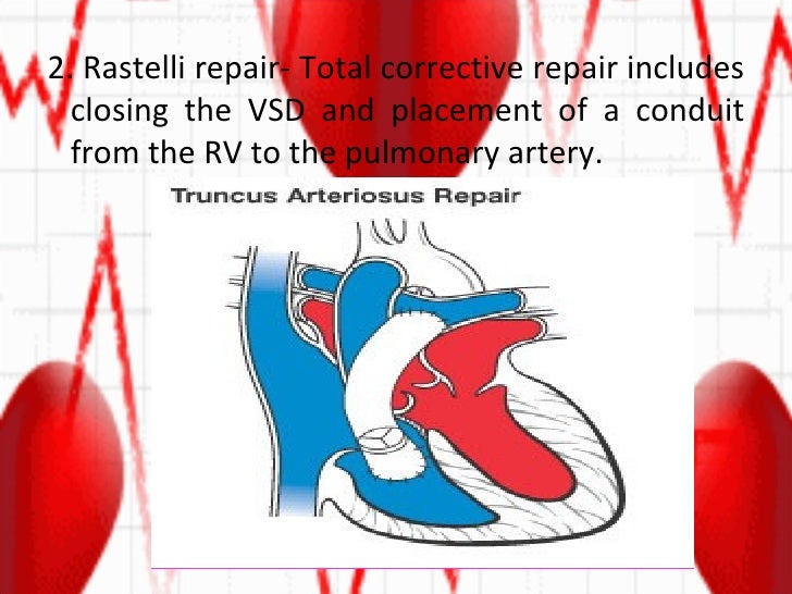 Cyanotic Heart Defects