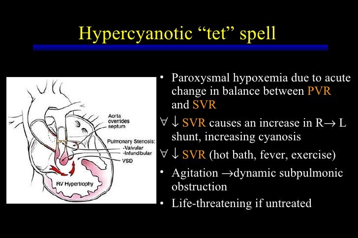 Cyanotic Heart Disease