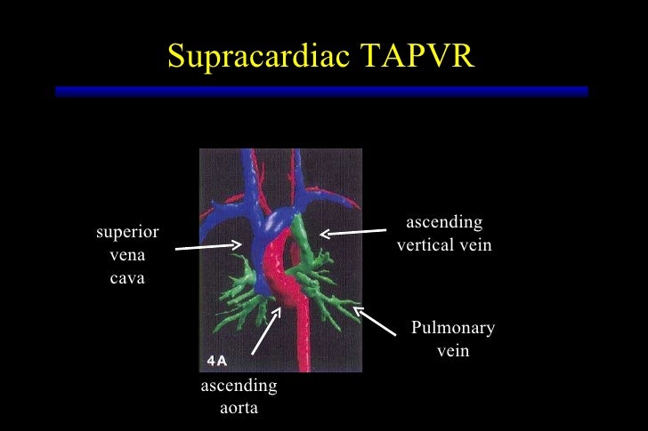 Cyanotic Heart Disease