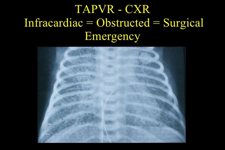 Cyanotic Heart Disease