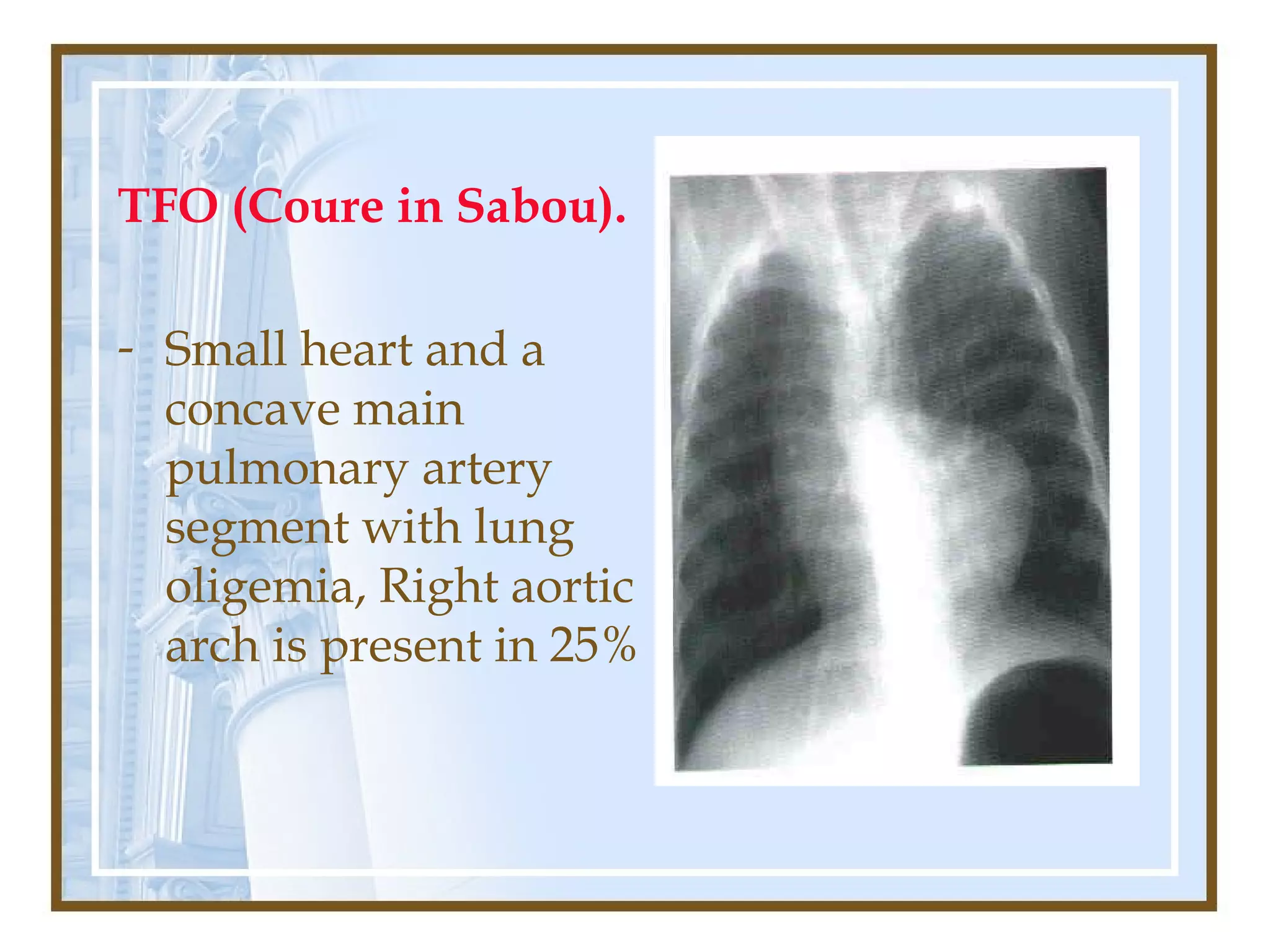 Cyanotic heart disease | PPS