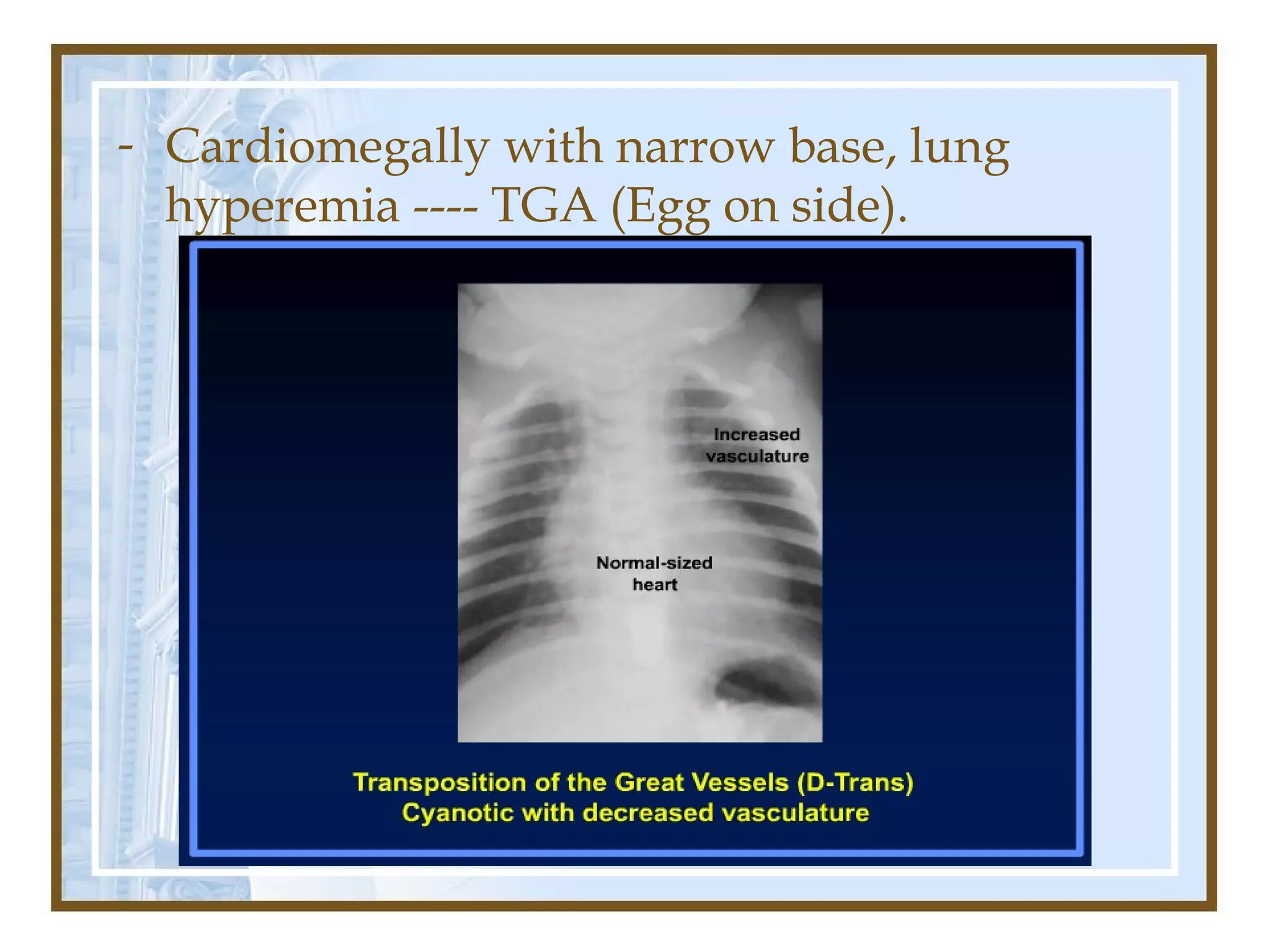 Cyanotic heart disease | PPS
