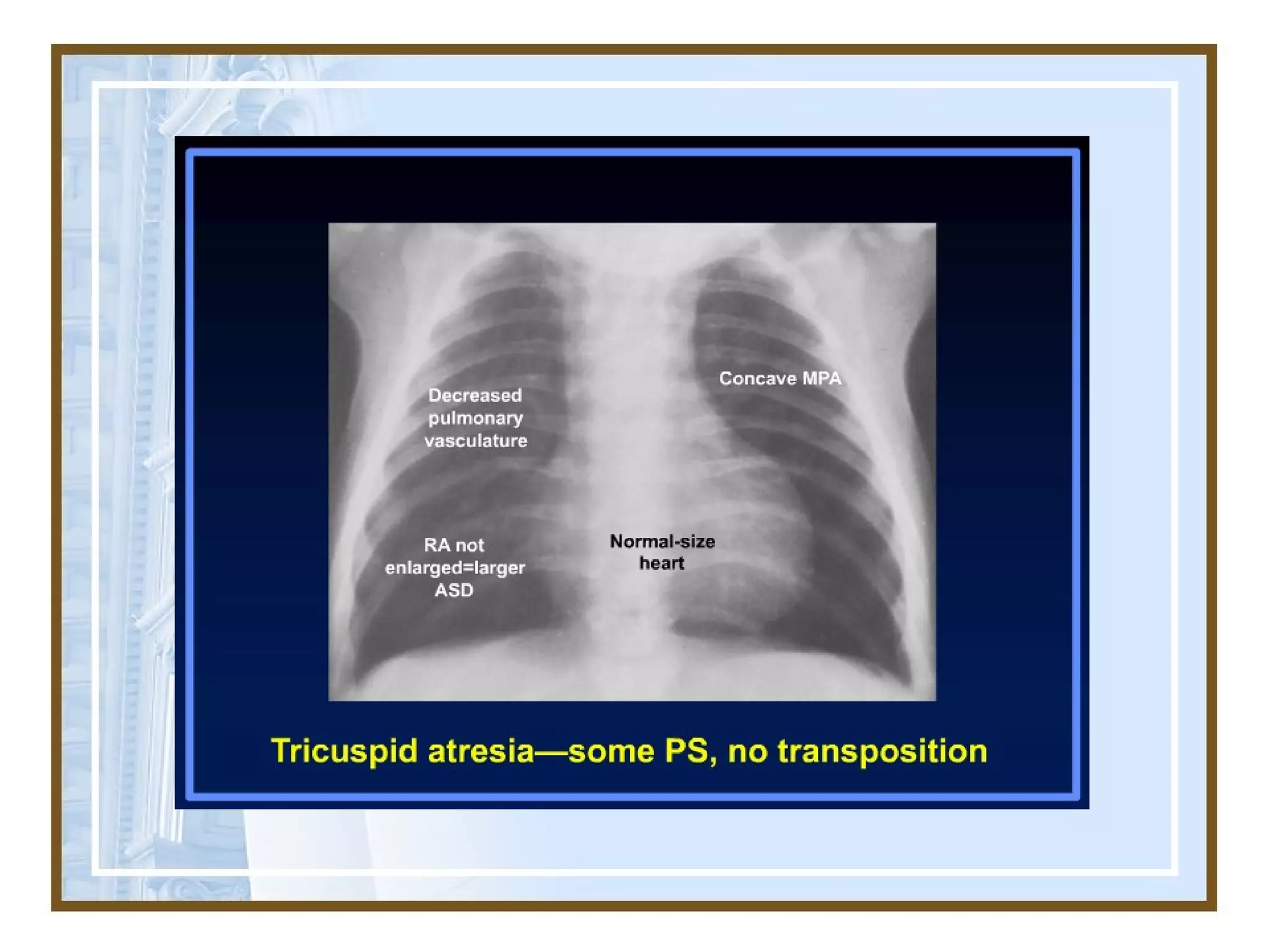 Cyanotic heart disease | PPS