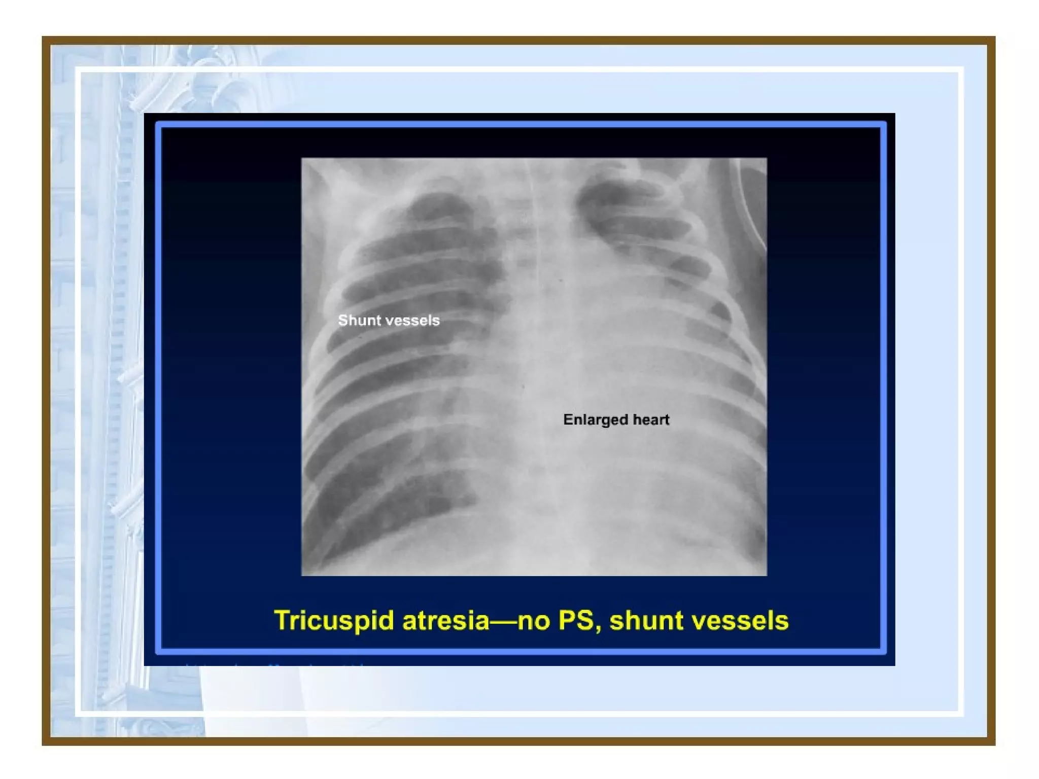 Cyanotic heart disease | PPS