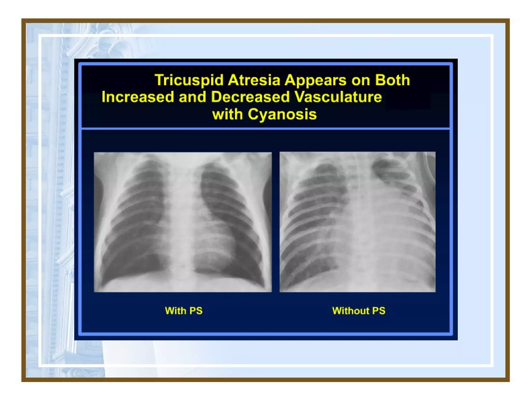 Cyanotic heart disease | PPS