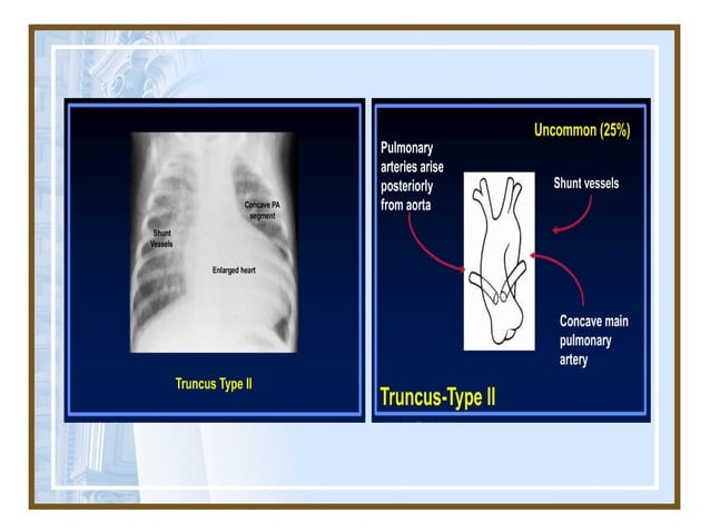Cyanotic heart disease | PPS | Heart and Cardiovascular Diseases ...