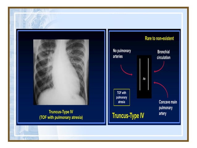 Cyanotic heart disease | PPS | Heart and Cardiovascular Diseases ...