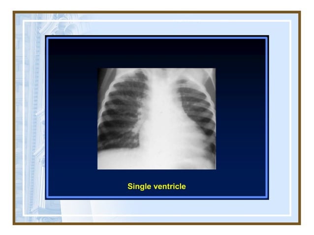 Cyanotic heart disease | PPS | Heart and Cardiovascular Diseases ...