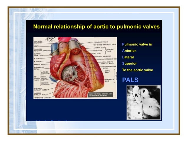 Cyanotic heart disease | PPS | Heart and Cardiovascular Diseases ...