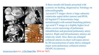 Cyanotic heart diseases | PPTX