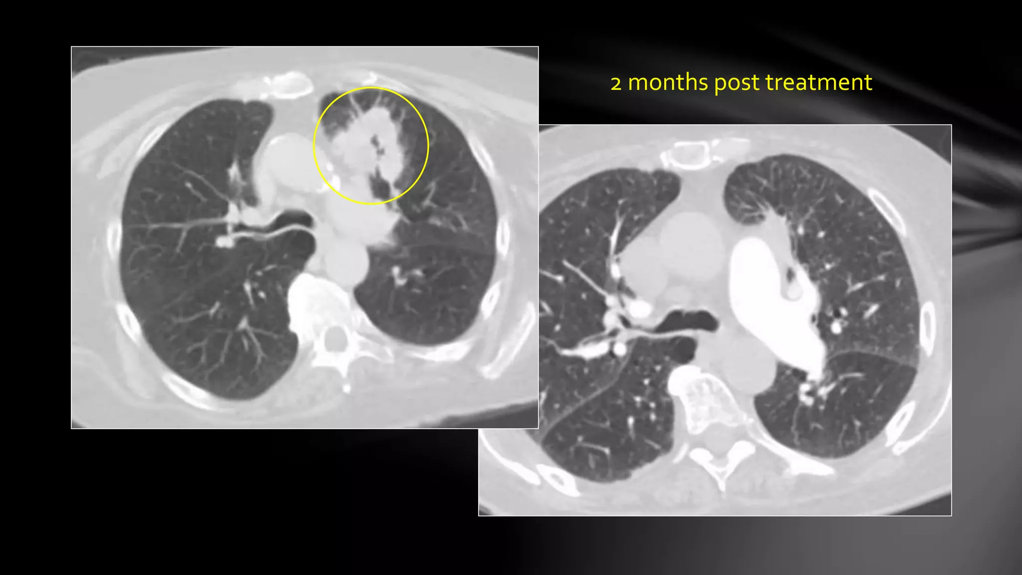CyberKnife: A New Option In the Treatment of Lung Cancer | PPTX