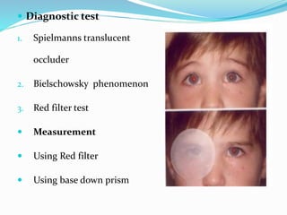 Cyclovertical deviation | PPTX