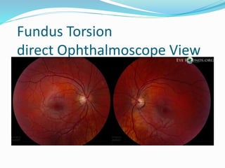 Cyclovertical deviation | PPTX