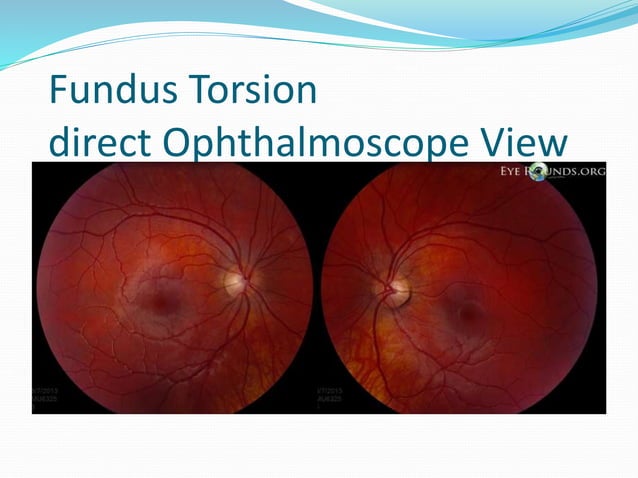 Cyclovertical deviation | PPTX | Eye and Vision Conditions | Diseases ...