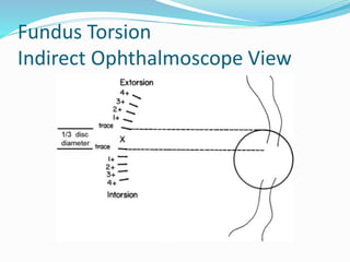 Cyclovertical deviation | PPTX