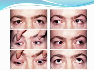 Cyclovertical deviation | PPTX