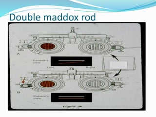Cyclovertical deviation | PPTX