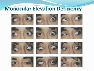 Cyclovertical deviation | PPTX