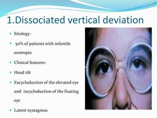 Cyclovertical deviation | PPTX