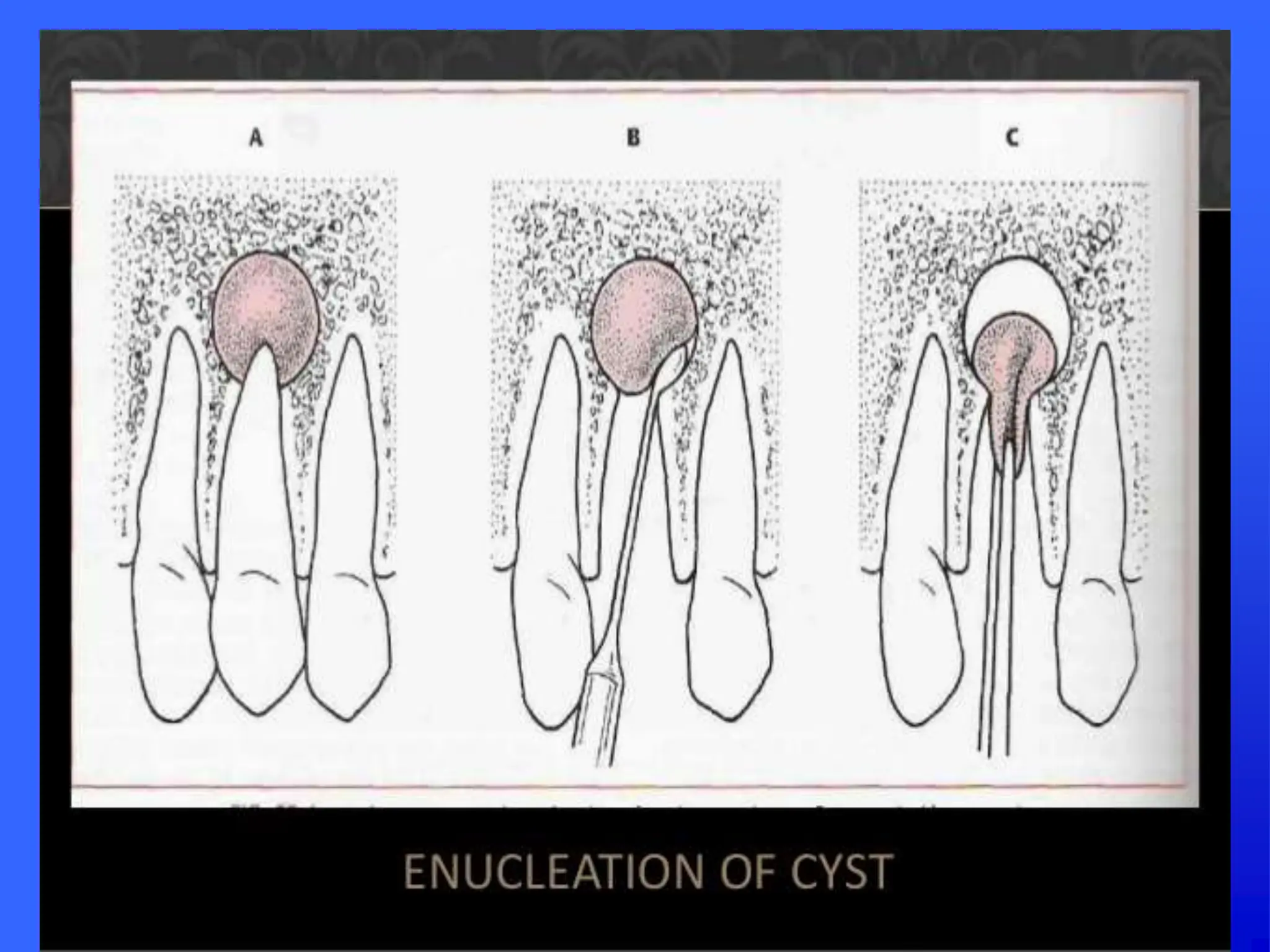 cycst of oral cavity pathology og llg cydydPT | PPT