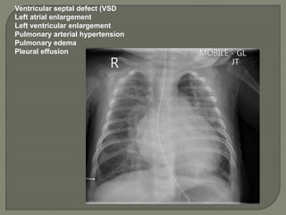 Ventricular Septal Defect X Ray