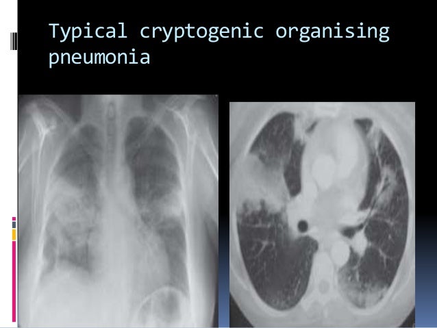 Cyptogenic orgnaising pneumonia