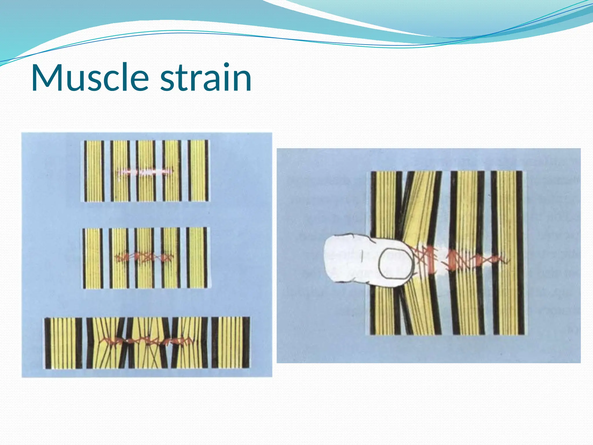 Cyriax concept...................... .ppt