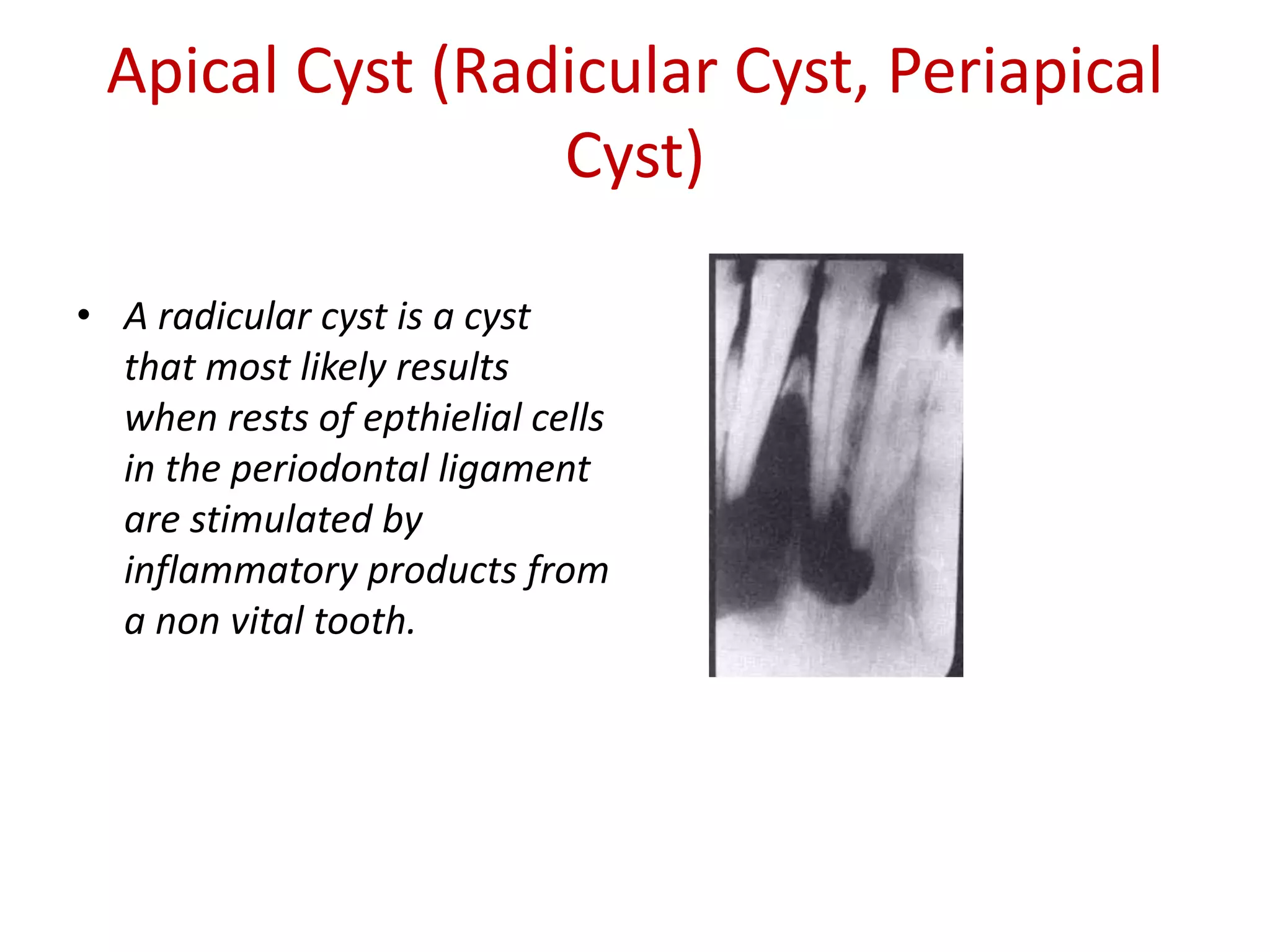 Cyst | PDF