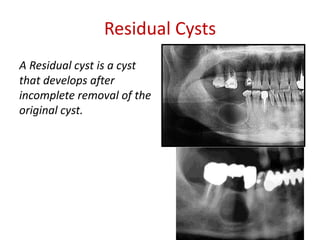 Residual Cyst