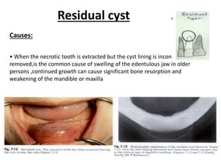 Cyst | PPTX