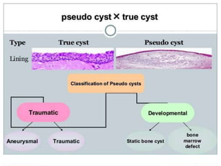 Cyst | PPTX