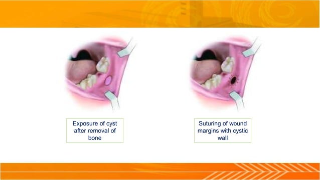 Cyst of the jaw | PPTX | Dental Health | Diseases and Conditions